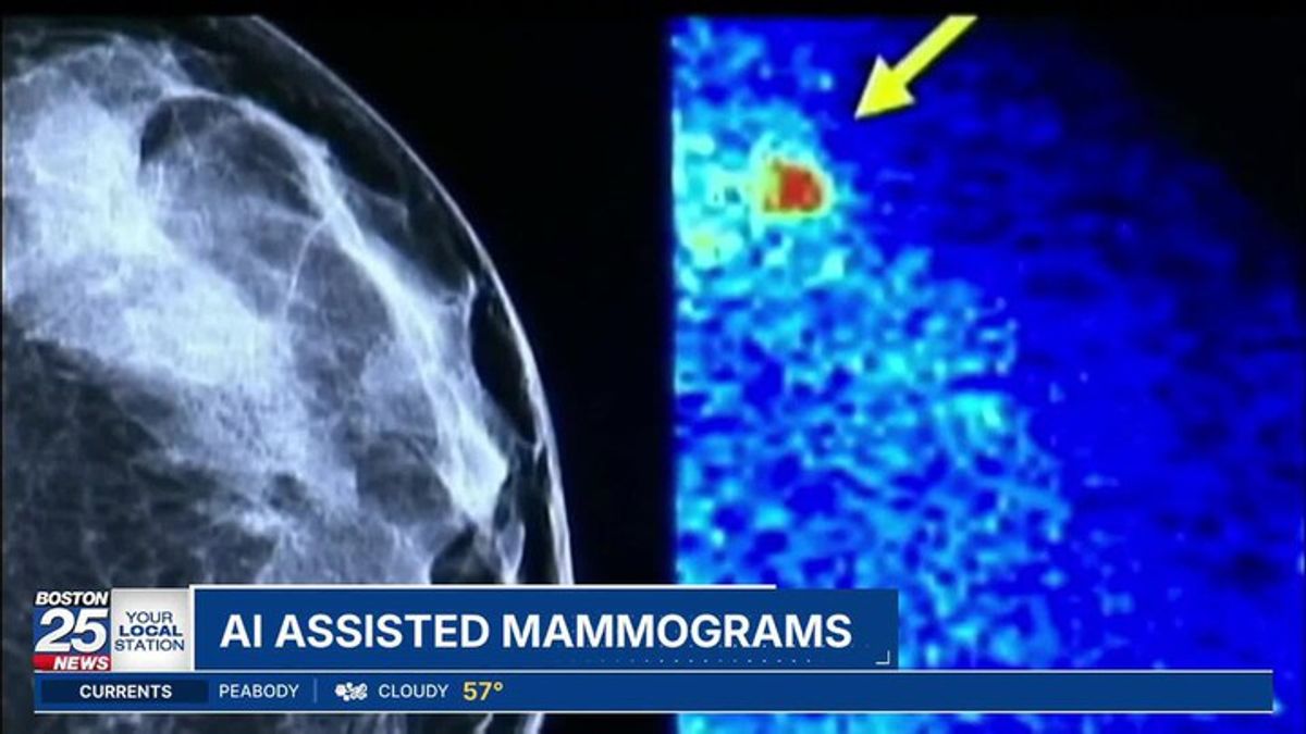 AI-powered mammograms may detect breast cancer early, new study finds ...
