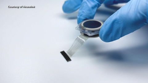 1st human brain chip implant patient gives insight into post-surgery ...