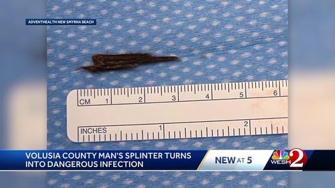 Volusia County man nearly loses hand after splinter turns into ...